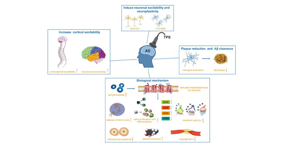 รักษาอัลไซเมอร์ด้วย TPS (Transcranial pulse stimulation in Alzheimer's ...